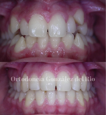 Colmillos montados ¿Es este tu problema? - Ortodoncia González del Río