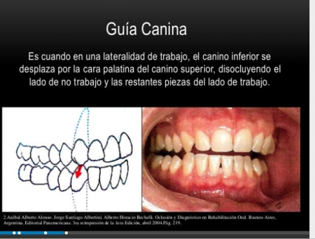 Colmillos montados ¿Es este tu problema? - Ortodoncia González del Río