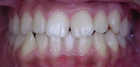 Dientes separados: lo que debes saber